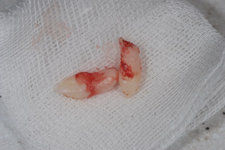 [세곡동 치과] 정중 과잉치 발치 : 네이버 블로그