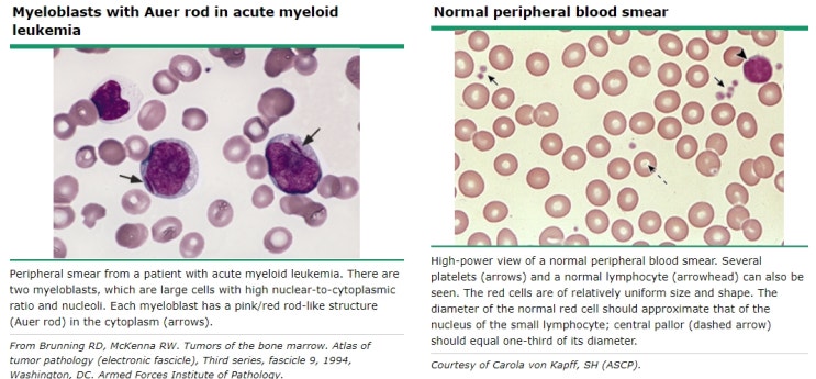 Auer rods, Auer bodies : 네이버 블로그