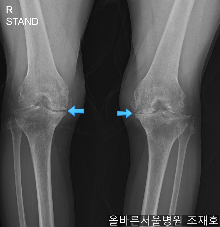 심한 내반 변형에서 동시에 시행한 양쪽 무릎 인공관절(TKRA at severe genu varum deformity)/올바른 ...