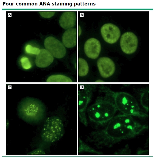 항핵항체 염색 양상의 의미, Significance of ANA staining patterns : 네이버 블로그