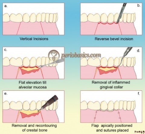 치주학 - 근단변위판막술 (APF) : 네이버 블로그