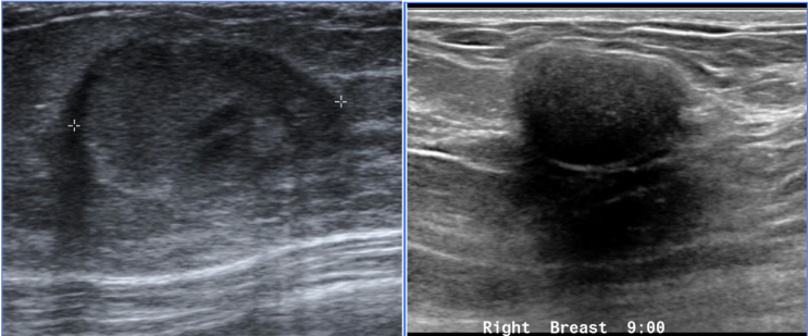 galactocele(milk retention cyst) : 네이버 블로그
