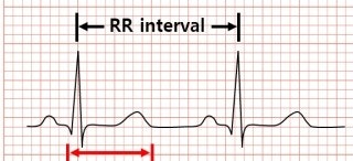 QT간격 연장증후군(long QT syndrome, LQTS) : 네이버 블로그
