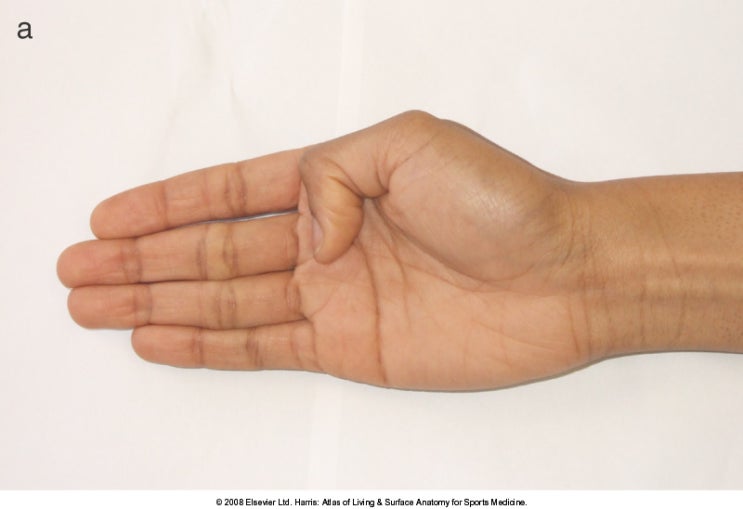 핀켈스테인 검사 (Finkelstein's test) - 드퀘르벵 증후군 (DeQuervain syndrome, 손목건초염 ...