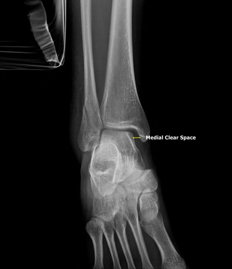 Ankle Gravity stress view : 네이버 블로그