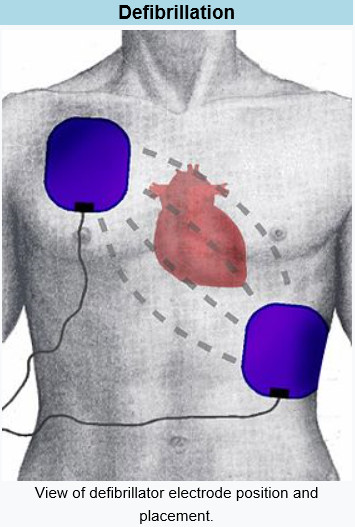 defrillator : 네이버 블로그