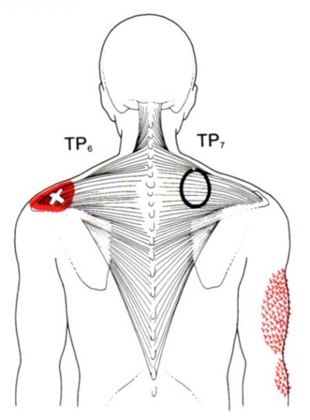 부위별 근육별 통증유발점과 방사통 Trigger point & Referred pain [근막통증증후군 MPS TPI 연수교육 ...