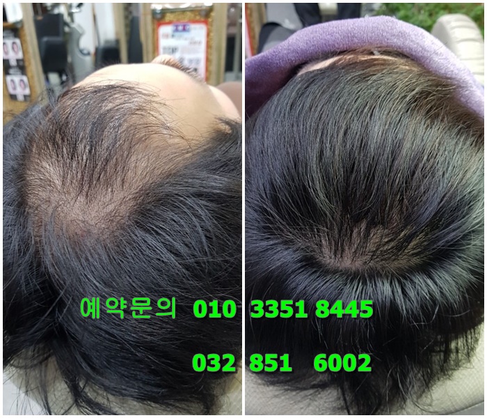 남자증모술 인천증모술 송도헤어증모 앞머리증모 정수리증모 남자붙임머리 네이버 블로그