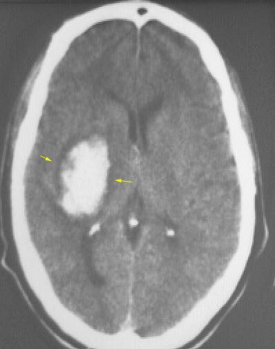 뇌내출혈 #ICH ; Intracerebral hemorrhage : 네이버 블로그