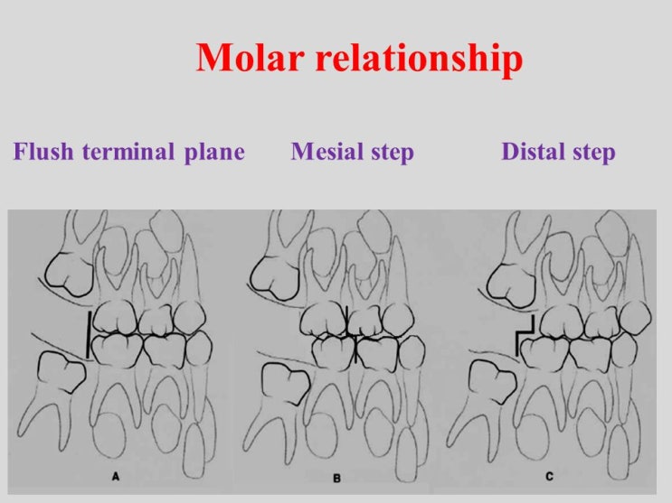 김포 성장교정/ 우리 아이 주걱턱인가요? 유치 교합관계에 대하여 : 네이버 블로그