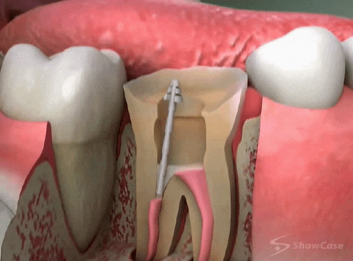 [포스트, Endodontic post] 신경치료 후 크라운을 연결하는 기둥 : 네이버 블로그