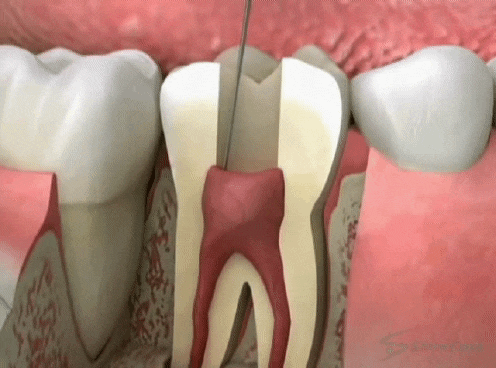 [근관치료 과정, Endodontics procedure] 신경치료의 단계적 진행 : 네이버 블로그