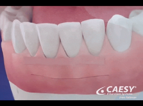 [유리치은이식술, Free gingival graft] 약한 잇몸을 튼튼하게 만들어주는 잇몸이식 : 네이버 블로그