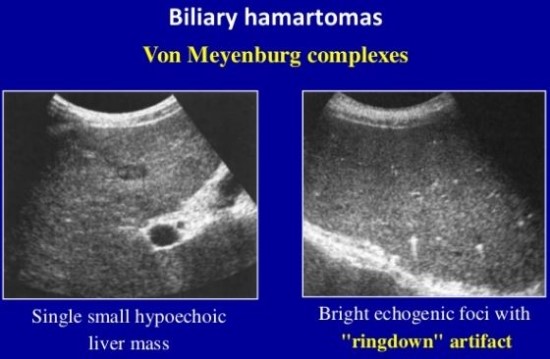 [Liver] Biliary hamartoma (담도과오종) : 네이버 블로그