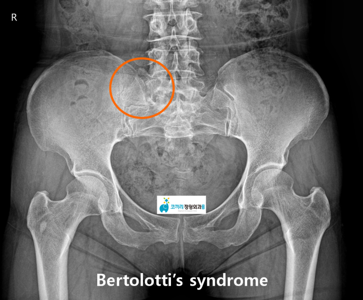 김해도수치료잘하는곳 - Bertolotti’s syndrome 또는 요천추 이행성 척추(Lumbosacral Transitional Vertebrae) : 네이버 블로그