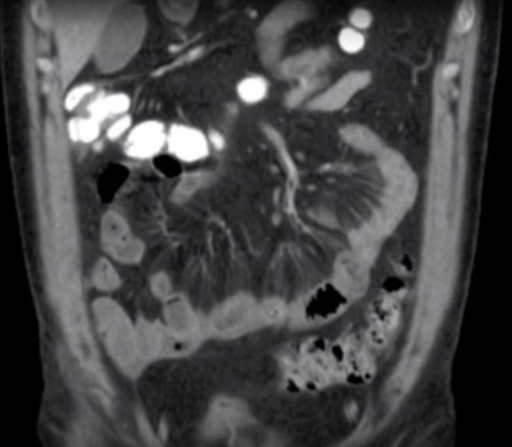 Comb sign, Crohn disease, CT : 네이버 블로그