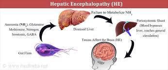 간성 뇌증 HEPATIC ENCEPHALOPATHY CBD오일 : 네이버 블로그