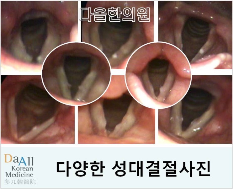 쉰목소리원인 성대폴립과 성대결절 치료 임상사례가 많은 다올한의원 치료과정과 치료방법소개 네이버 블로그