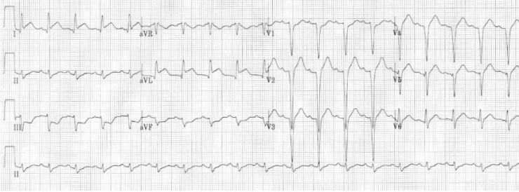 High lateral myocardial infarction (STEMI) : 네이버 블로그