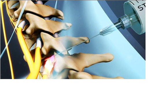 신경근차단술(Selective nerve root injection) : 네이버 블로그