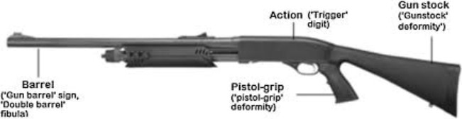 gun stock deformity(cubitus varus) : 네이버 블로그