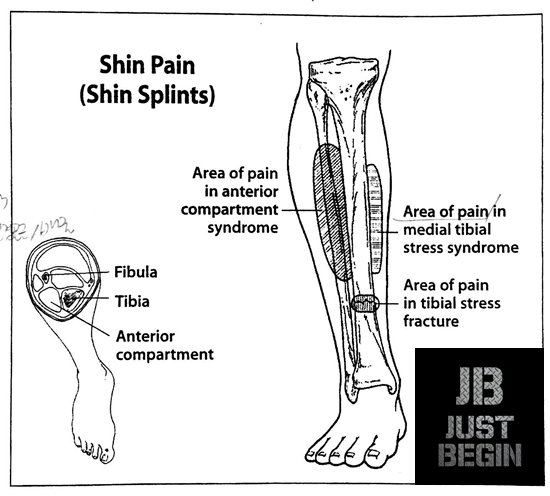 Shin Pain(Shin Splints) 정강이통증 발생, 증상, 진단, 치료 : 네이버 블로그