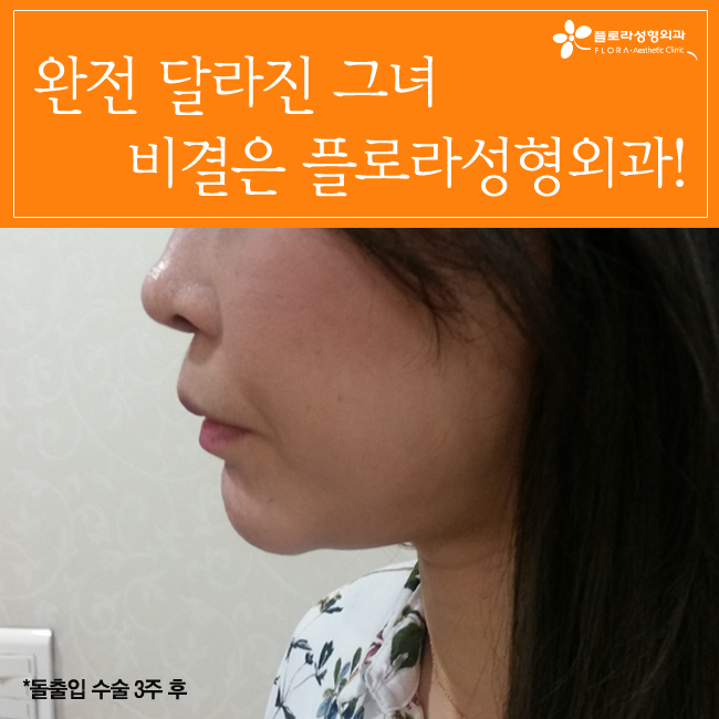돌출입수술후 돌출입수술후기에 플로라성형외과에서했다고하던데..^^ : 네이버 블로그