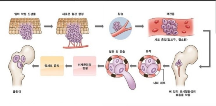 뼈전이 전이성 골종양으로 인한 압박골절의 원인과 치료 Feat 긴급 경피적 척추성형술골시멘트 시술 네이버 블로그