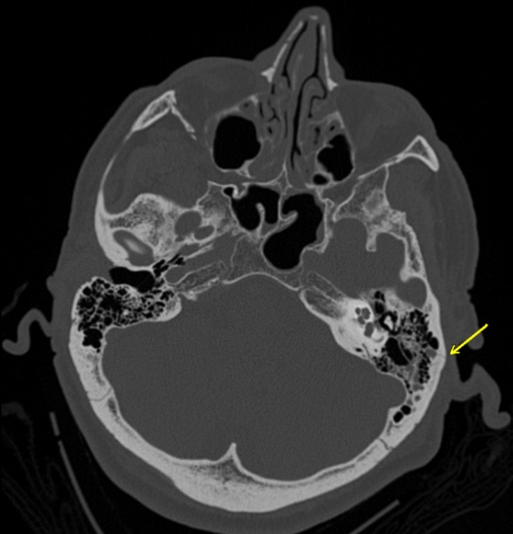 basal skull fracture (skull base fracture, 두개저 골절) : 네이버 블로그
