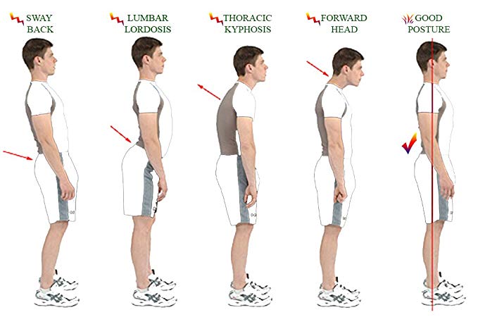 Sway Back - 굽은등 : 네이버 블로그