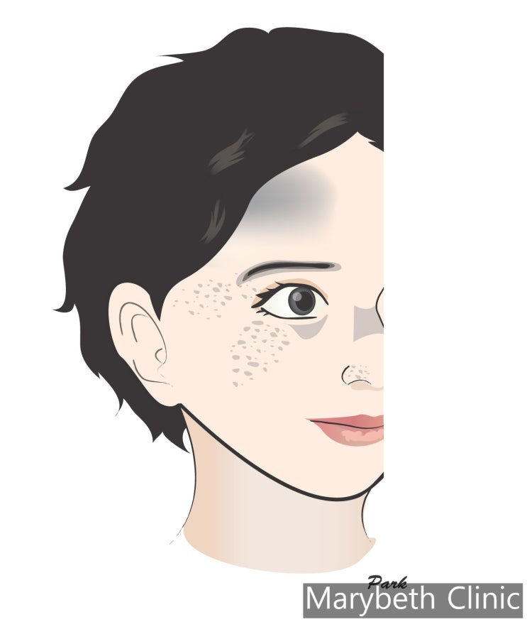 후천양측오타모반모양반점(Acquired bilateral nevus of Ota-like macules, ABNOM) 호리모반 ...