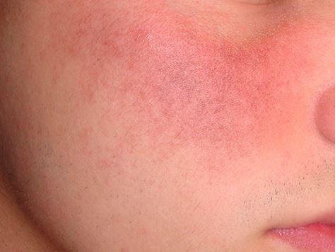 주사피부염 (Rosacea) 자세한 원인, 증상, 치료 by 피부과전문의 : 네이버 블로그