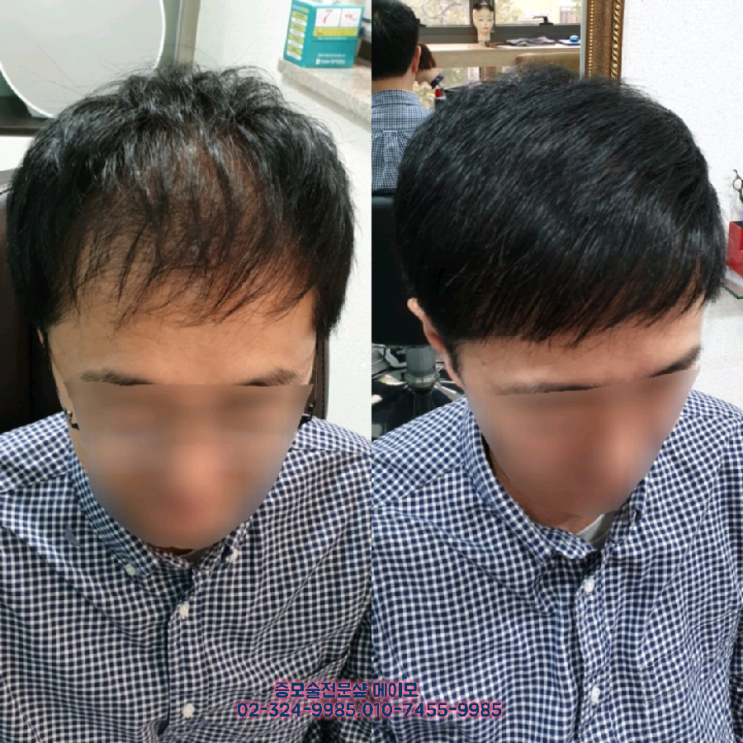 분당증모술 남자붙임머리 가격보다 견인성탈모 없는 완벽한 시술비법 공개 네이버 블로그