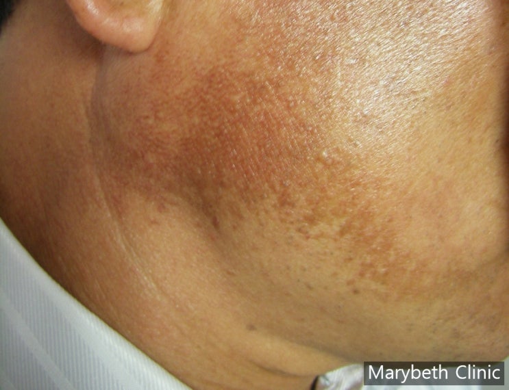 시바트 다형피부증(Poikiloderma of Civatte) - 메어리의원 정종영 원장 : 네이버 블로그