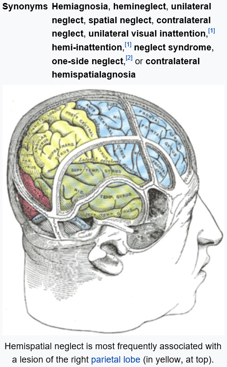 hemispatial neglect (inattention) : 네이버 블로그