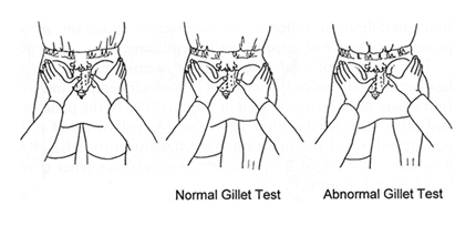 청주 도수치료) 질렛 테스트 : 네이버 블로그