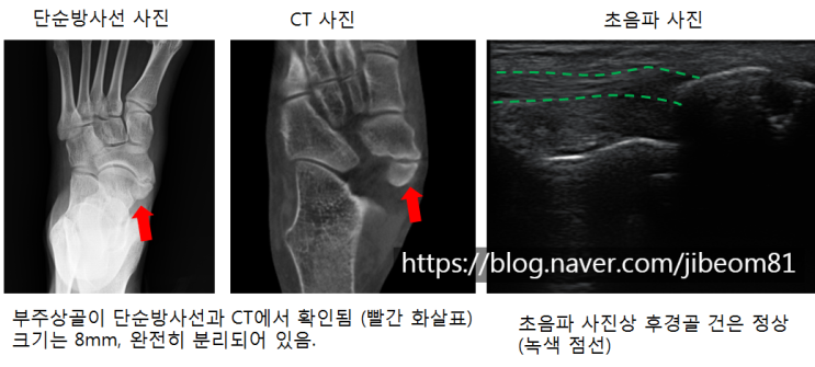 부주상골 증후군의 실제 치료 사례 걸으면 발목 내측이 아파요 부주상골과 발의 변형을 같이 수술한 사례 족부 정형외과