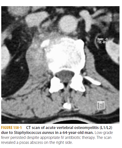 척추 골수염(Vertebral osteomyelitis) : 네이버 블로그
