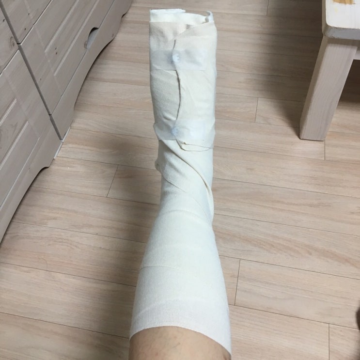 발등골절일기 21일차 반깁스냐 통깁스냐 중족골골절 네이버 블로그