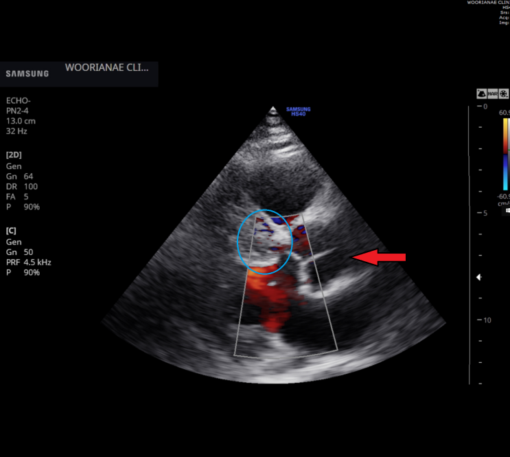 심장 초음파에서 관찰된 정상 변이, sigmoid septum, lambl's excrescences (램블 증식물 ...