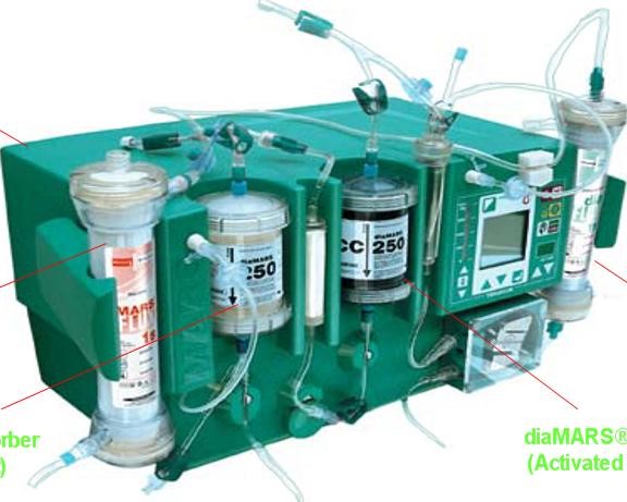 "간도 투석을 해?" 간 투석(Liver dialysis) = MARS(Molecular Adsorbents ...