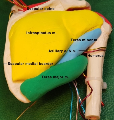 Teres major muscle 대원근 인대강화주사 : 네이버 블로그