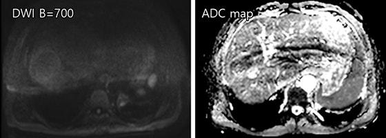 간 MRI의 확산강조영상(diffusion weighted image) : 네이버 블로그