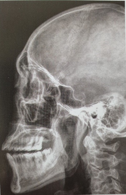 facial bone lateral projection : 네이버 블로그