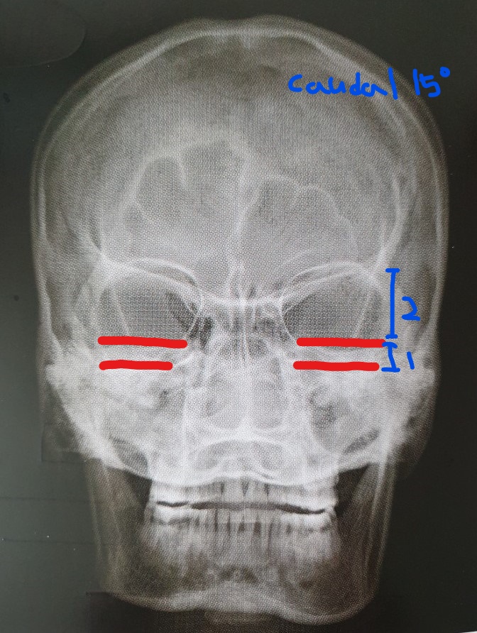 facial bone PA axial projection = Caldwell법 : 네이버 블로그