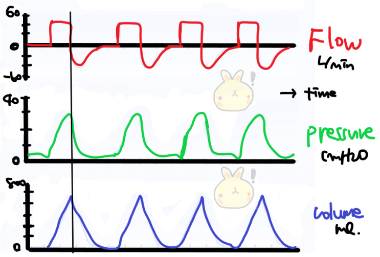 Ventilator(기계환기): ACMV(Assist Control Mandatory Ventilation) 특징과 그래프 해석 ...