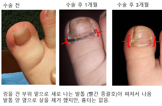 내향성 발톱의 교정 실제사례 발톱이 휘어서 볼이 좁은 신발을 신거나 부딪치면 아파요 링을 이용한 내향성 발톱 교정 수술