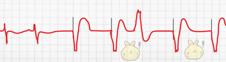 인공심장박동기(pacemaker) : VVI mode 심전도(ecg) 해석 : 네이버 블로그