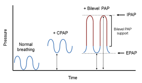 · BiPAP / NPPV(NIV) : 네이버 블로그