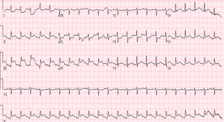 심장눌림증(Cardiac tamponade) 심전도(ecg) 특징과 Beck's triad : 네이버 블로그
